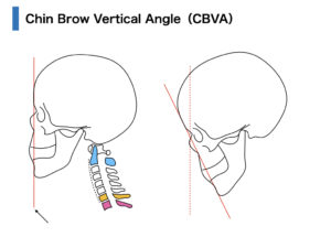 Chin‒Brow Vertical Angle（CBVA） | 脊椎徒手療法研究所
